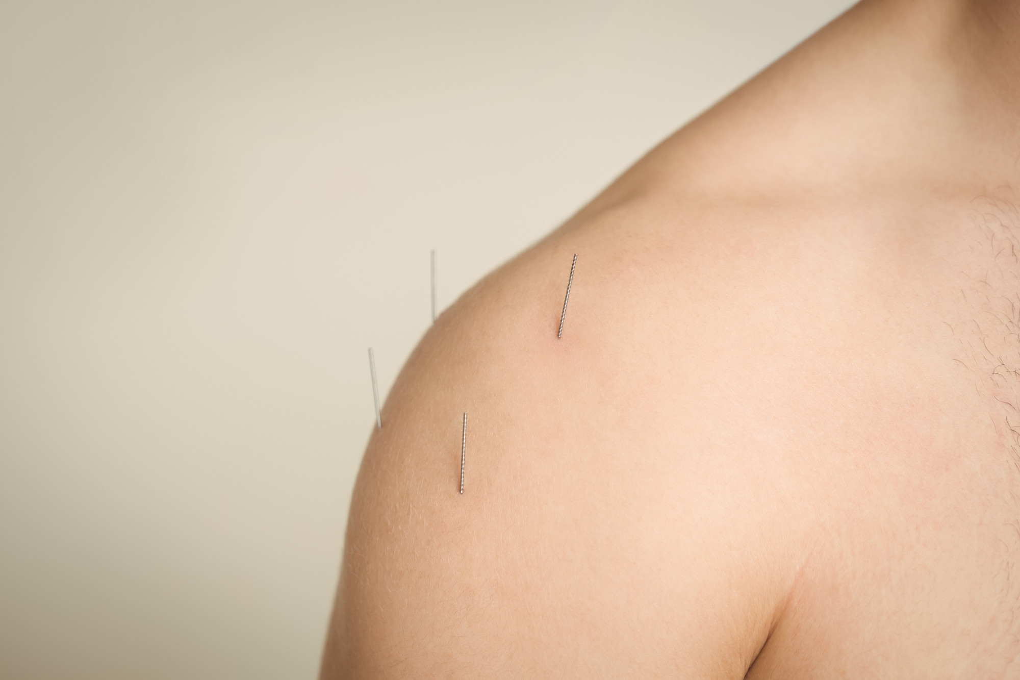 Acupuncture: Anxiety and Stress Relief | London Holistic Health Clinic